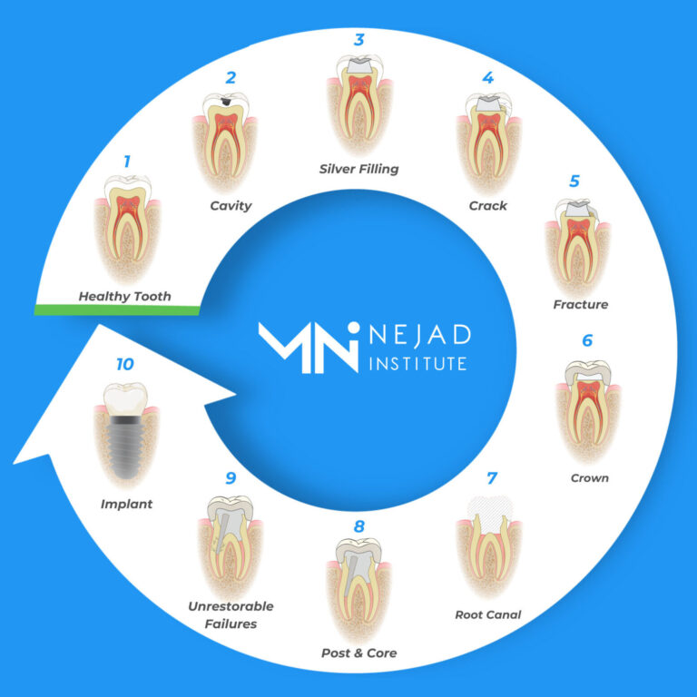 The Tooth Cycle of Death - Nejad Institute for Biomimetic Dentistry