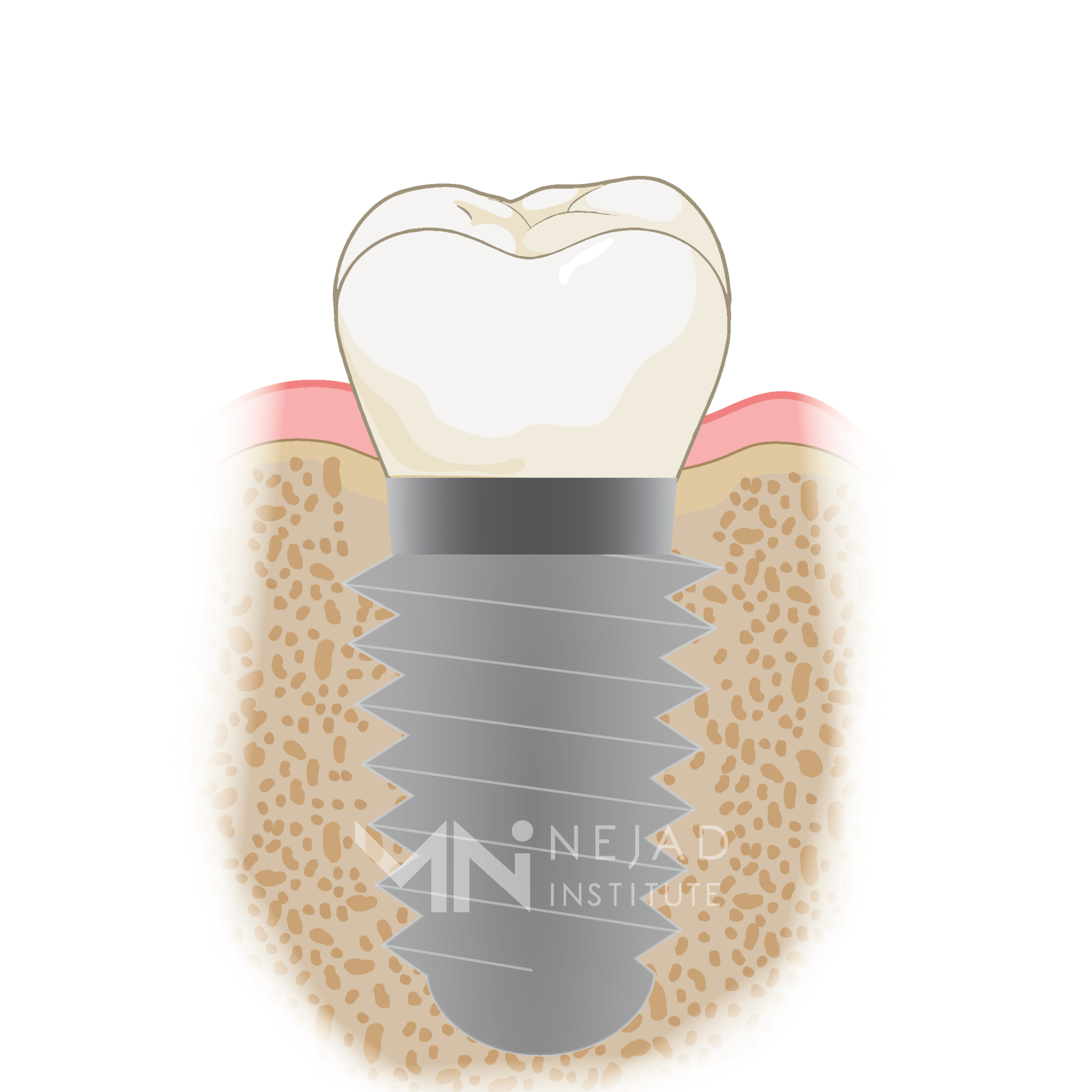 The Tooth Cycle of Death - Nejad Institute for Biomimetic Dentistry