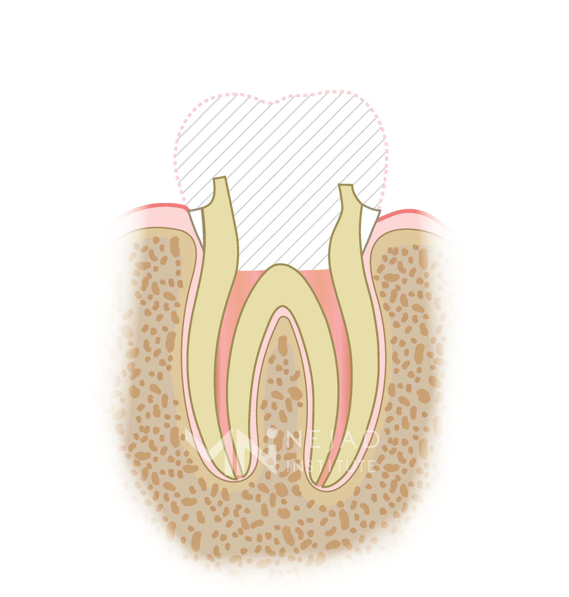 The Tooth Cycle of Death - Nejad Institute for Biomimetic Dentistry