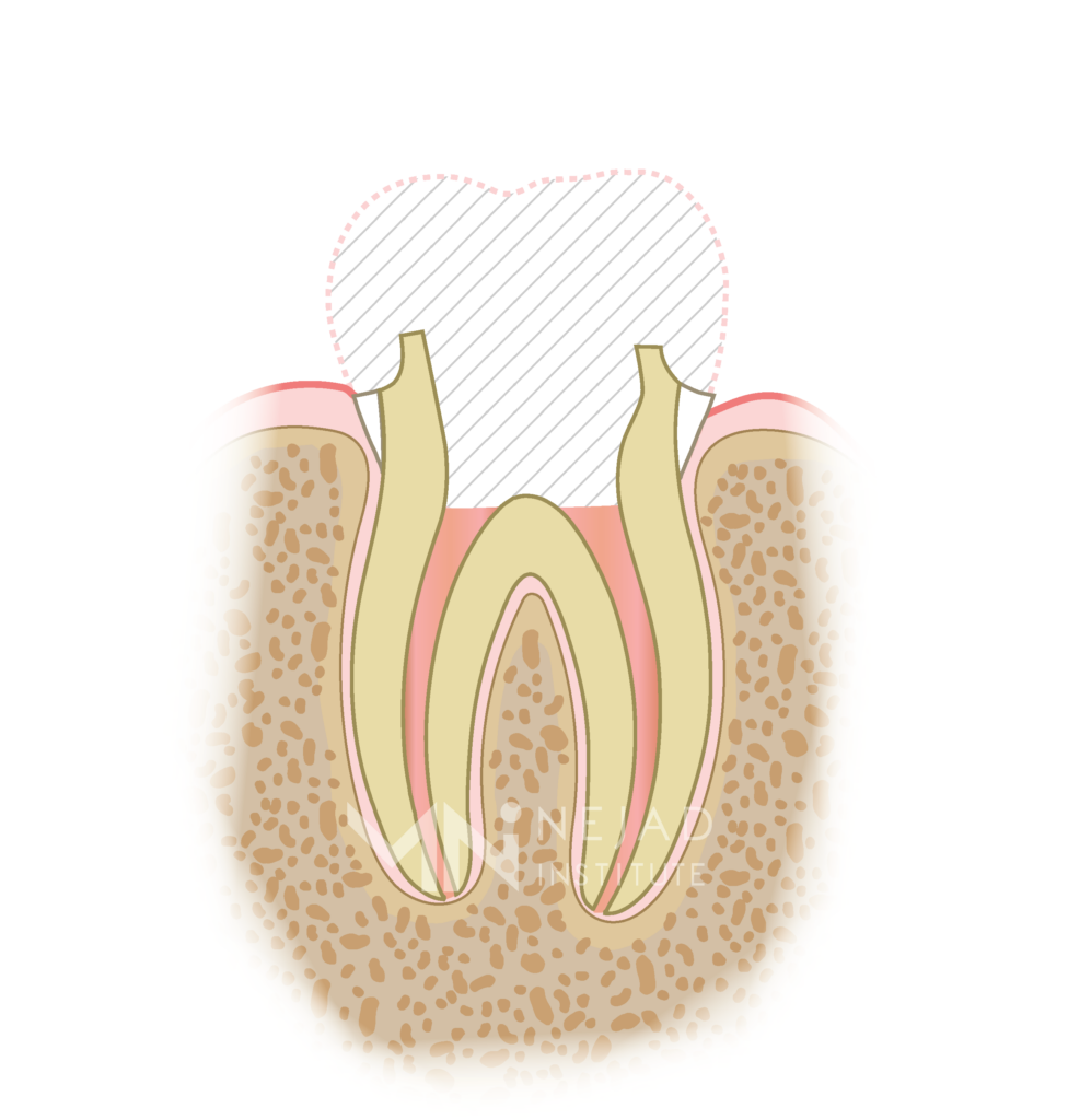The Tooth Cycle of Death - Nejad Institute for Biomimetic Dentistry